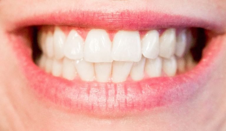 Clasificación de Caries - ¿Cómo se clasifican?